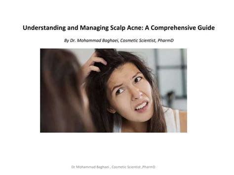 Understanding And Managing Scalp Acne A Comprehensive Guide Pptx Ppt