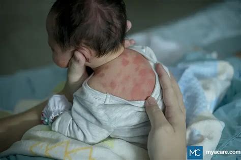 Erythema Toxicum Neonatorum Etn A Common Newborn Rash Mya Care