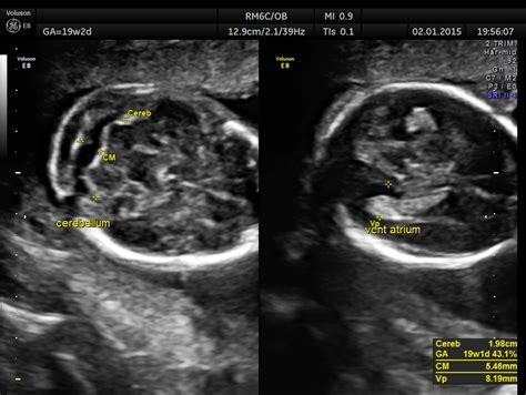 Fetal Pericardial Effusion Looking Through A Transducer