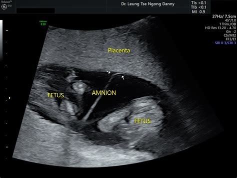 Lambda And T Sign In Twin Pregnancy Feature Of Dichorionic Diamniotic