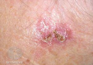 Skin Cancer How To Check Your Skin Harrogate Cancer Services