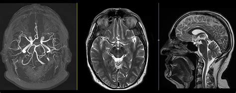 Mrt Des Kopfes Neurokranium Mrt Marburg