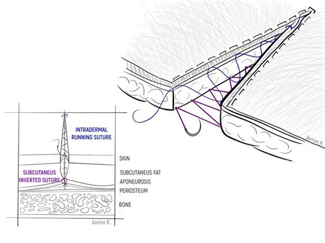 Schematic Representation Of A Cosmetic Intradermal Suture Without