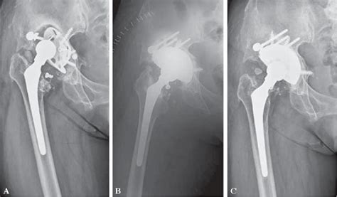 Figure 2 From Re Revision Of Failed Revision Total Hip Arthroplasty Acetabular Components