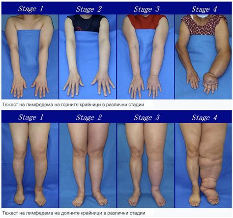 Етапи на развитие БА Лимфедем