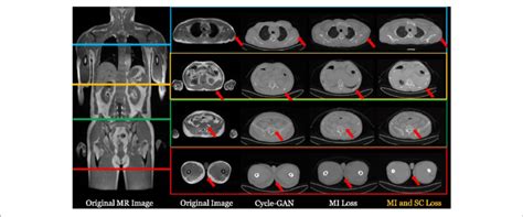 Typical Examples Of Synthesizing Ct Images From A Whole Body Mr Image Download Scientific