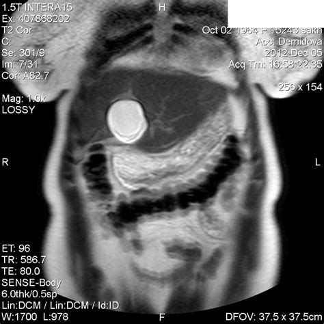 Киста печени Портал радиологов