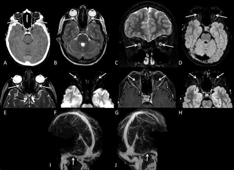 computed tomography ct without contrast revealing cerebrospinal