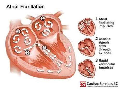 Heart Rhythm Interior Health