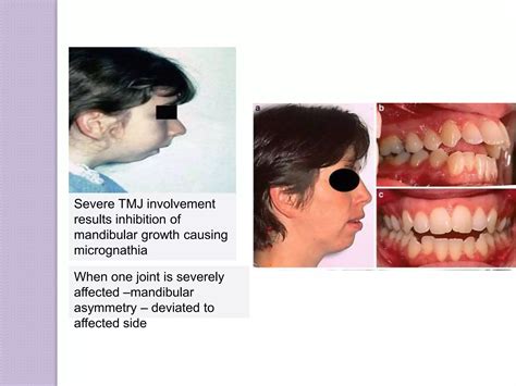 Tmj Temporomandibular Joint Disorders Pptx Bone And Joint Conditions Diseases And Conditions