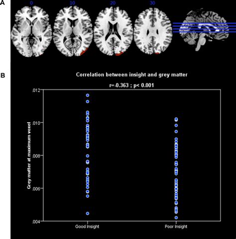 Voxel Based Morphometry Plos One