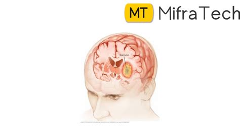 Brain Tumour Detection Using Deep Learning And Machine Learning Part