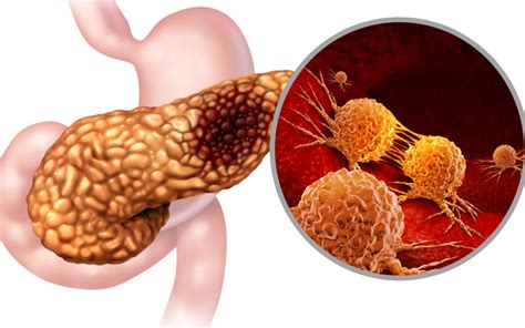 Pancreatic Cancer Resources Port Moody Health