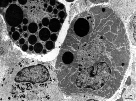 Plasma Cell Morphology In Multiple Myeloma And Related Disorders