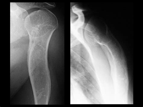 Anterior Shoulder Dislocation Findings Inferomedial Subcoracoid Displacement Of