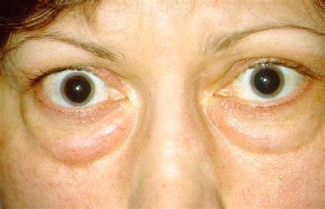 Pathology Outlines Orbit And Optic Nerve Dysthyroid Ophthalmopathy