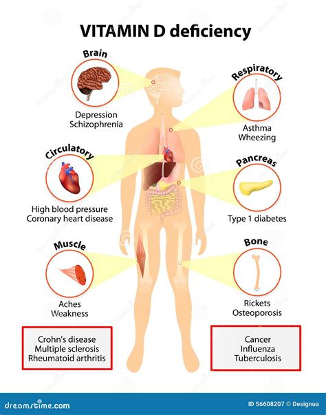 Deficiencia De La Vitamina D Síntomas Y Enfermedades Ilustración Del Vector Ilustración De