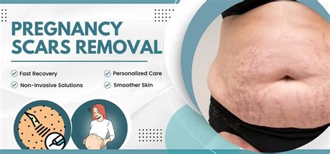 Pregnancy Stretch Marks Removal Treatment 1 Hospital India