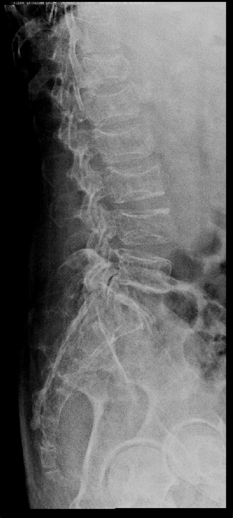 Bending Lumbar Spine X Ray At William Ferdinand Blog