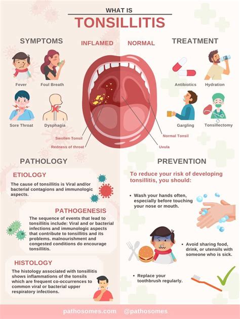 What Is Tonsillitis Artofit
