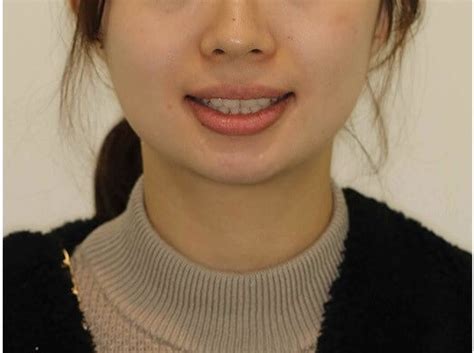 笑起来没问题深覆合可能正在伤害你的口腔 贝致案例库 贝致专业口腔服务平台权威医生真实案例一次看够