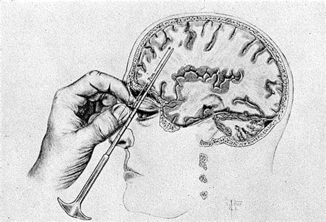 Looking Back Interpreting Lobotomy The Patients Stories Bps