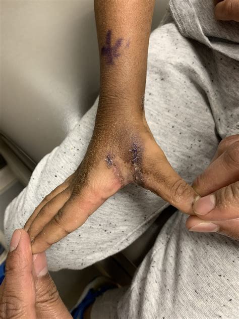 Tight First Webspace Congenital Hand And Arm Differences Washington University In St Louis