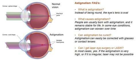 Astigmatism The Eye Practice