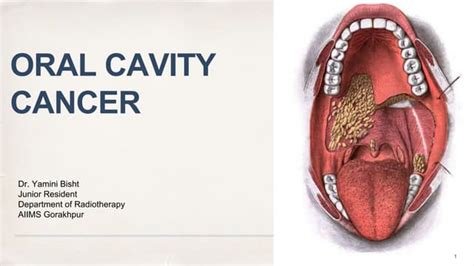 Oral Cavity Radiologypptx Radiation Oncology Pptx