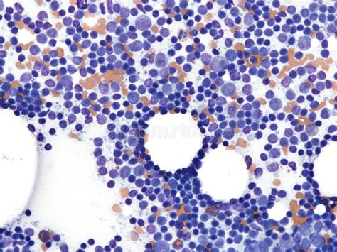 Follicular Lymphoma In Bone Marrow Cytology Stock Image Image Of