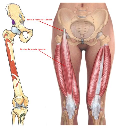 The Rectus Femoris Tendon And Piriformis Syndrome