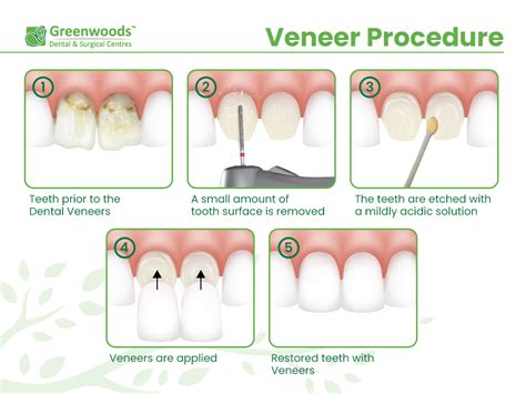 Porcelain Veneers Procedure