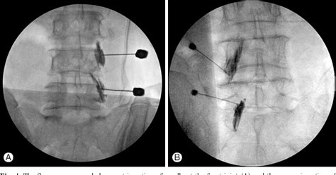 Facet Joint Medial Branch Nerve Block At Ann Bunch Blog