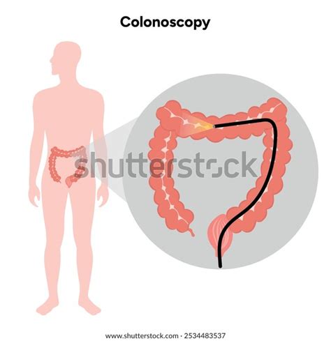 Colonoscopy Diagram Gastroscopy Endoscope Stock Vector Royalty Free