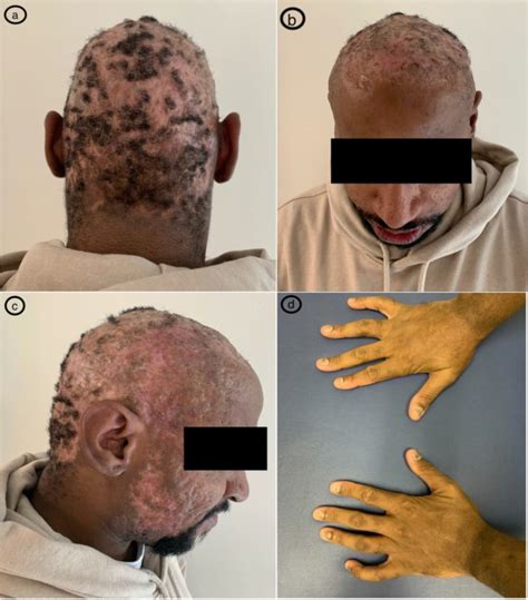 Dissecting Cellulitis