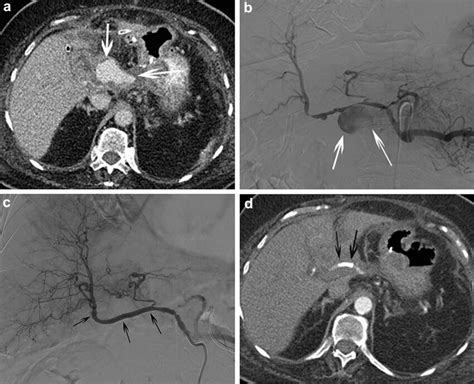 A 74 Year Old Woman With Extrahepatic Cholangiocarcinoma Who Underwent