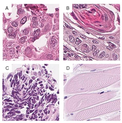 Lung Cancer Histology