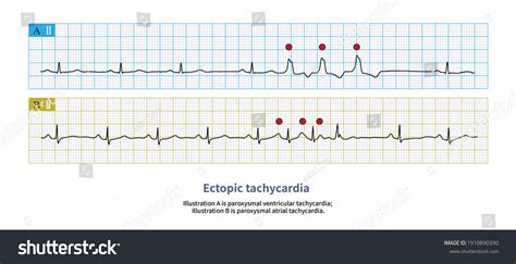 Atrial And Ventricular Ectopy