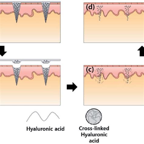 Pdf Microneedles Containing Cross Linked Hyaluronic Acid Particulates For Control Of