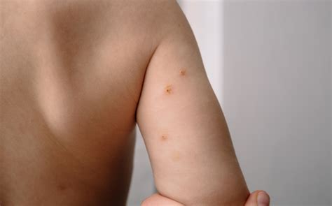 Контагиозный моллюск Разработано новое средство для лечения без хирургического вмешательства