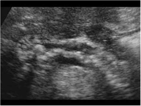 Abdomen And Retroperitoneum 1 3 Pancreas Case 1 3 7 Pancreas Calcifications Ultrasound Cases