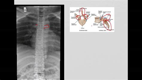 How To Read A Thoracic Spine X Ray At Mackenzie Balfour Blog