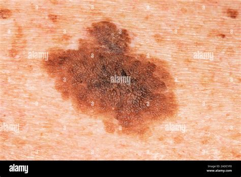 Neurofibroma On The Skin Of A 70 Year Old Man Neurofibroma Growths