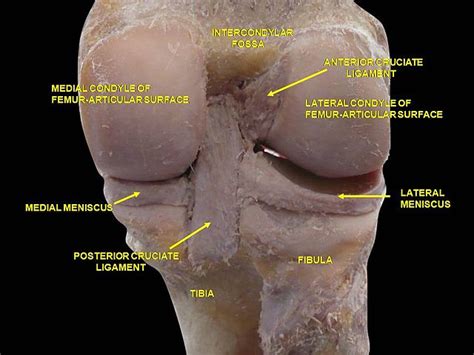 Sulcus Terminalis Femur