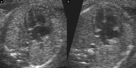 The Four‐chamber View Four Reasons Why It Seems To Fail In Screening