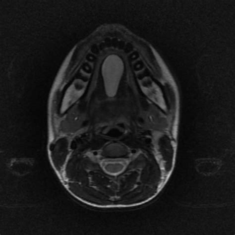 Radiopaedia Case Dermoid Cyst Of Floor Of Mouth Id 23100 Study 23130