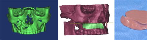 Figure 1 From Validity Of Peek Patient Specific Implant Psi Containing Autogenous Bone Graft