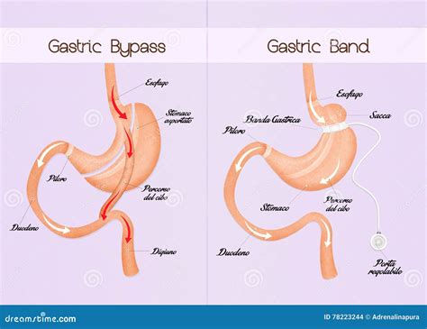 Gastric Bypass