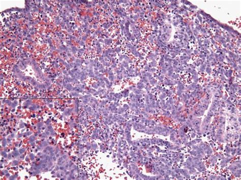 Nonneoplastic Lesions Of The Endometrium Clinical Tree