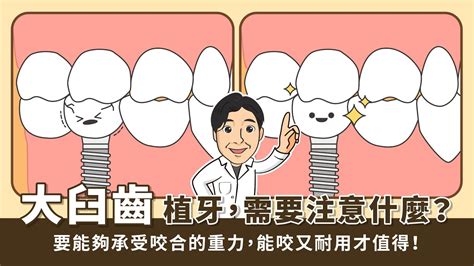 【植牙案例】大臼齒植牙，需要注意什麼？要能夠承受咬合的受力，能咬又耐用才值得！ Youtube